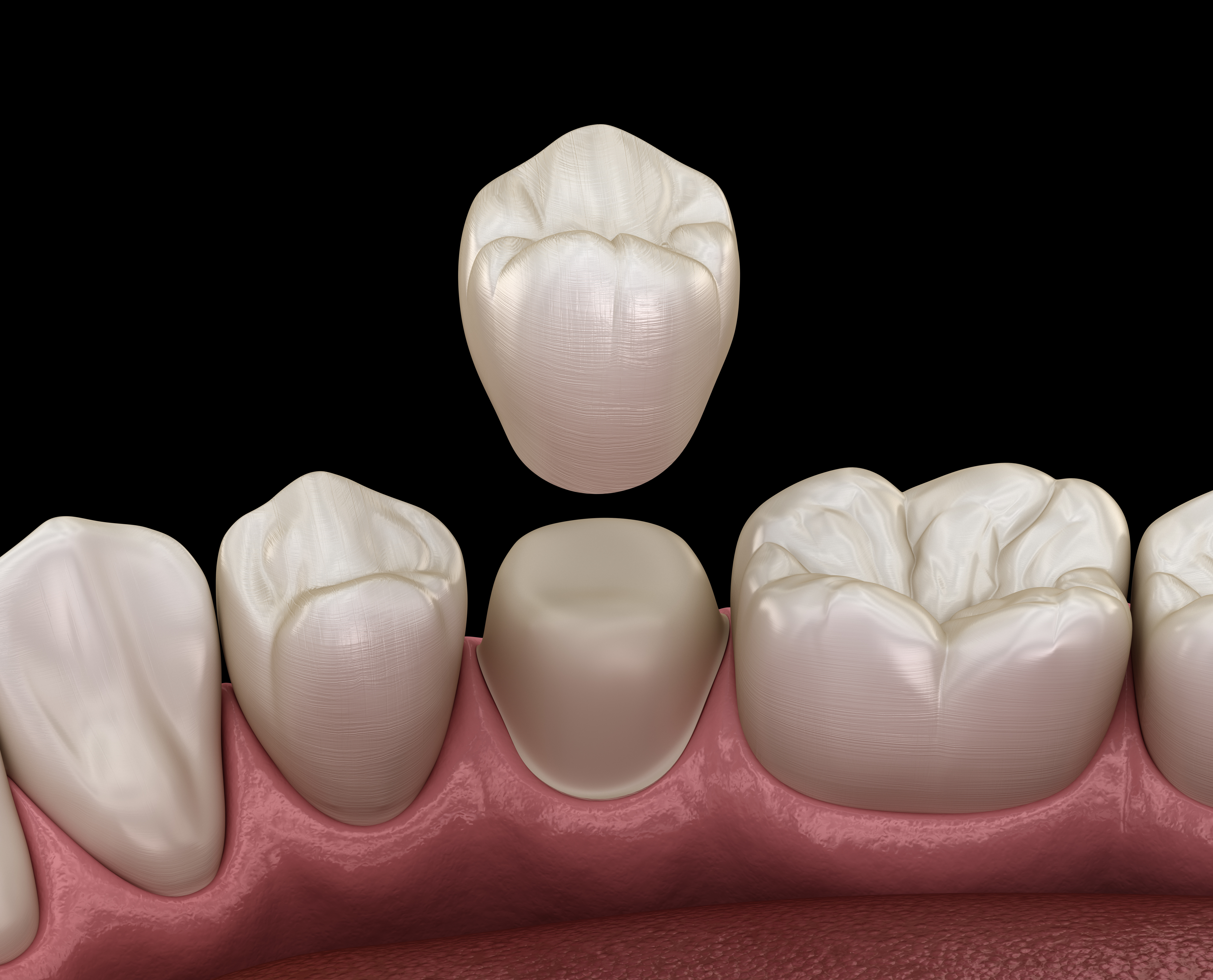 Dental crown premolar tooth assembly process. Medically accurate 3D ...